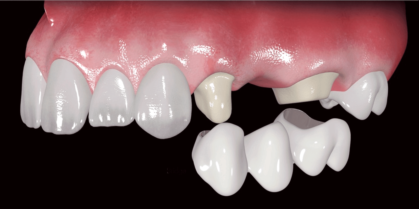 Prótese Fixa - Departamento de Odontologia Restauradora